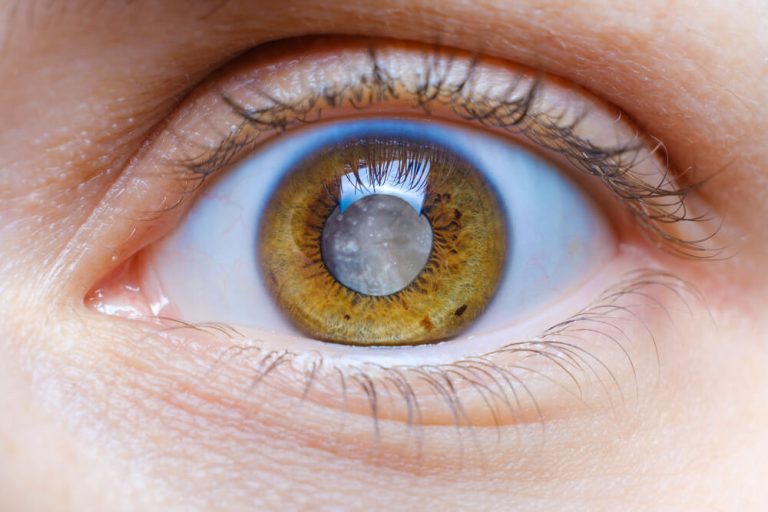 How do Cataracts Form? – SuraVision